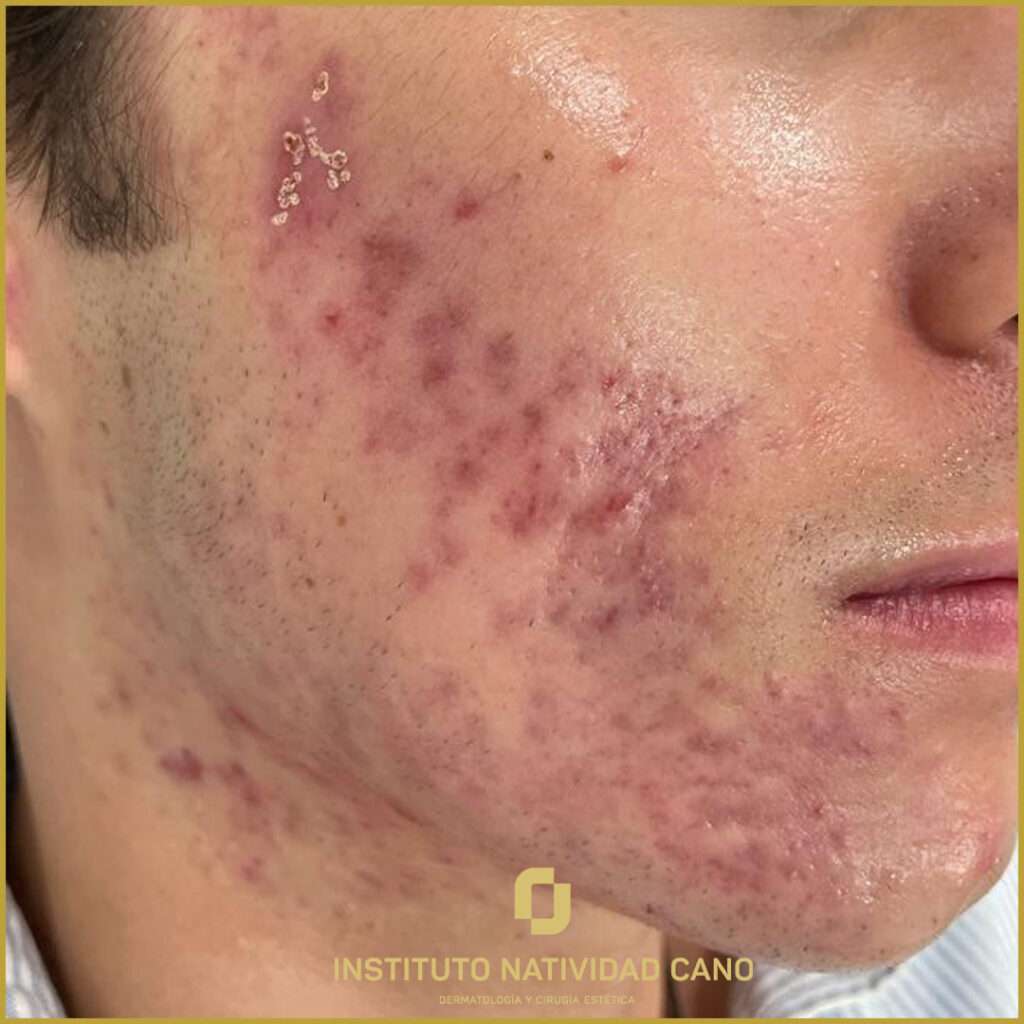 Acné - Instituto Médico Natividad Cano
