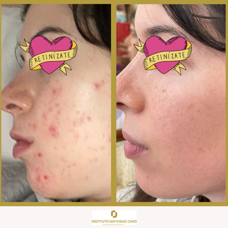 Manejo integral y rejuvenecimiento de labio | Natividad