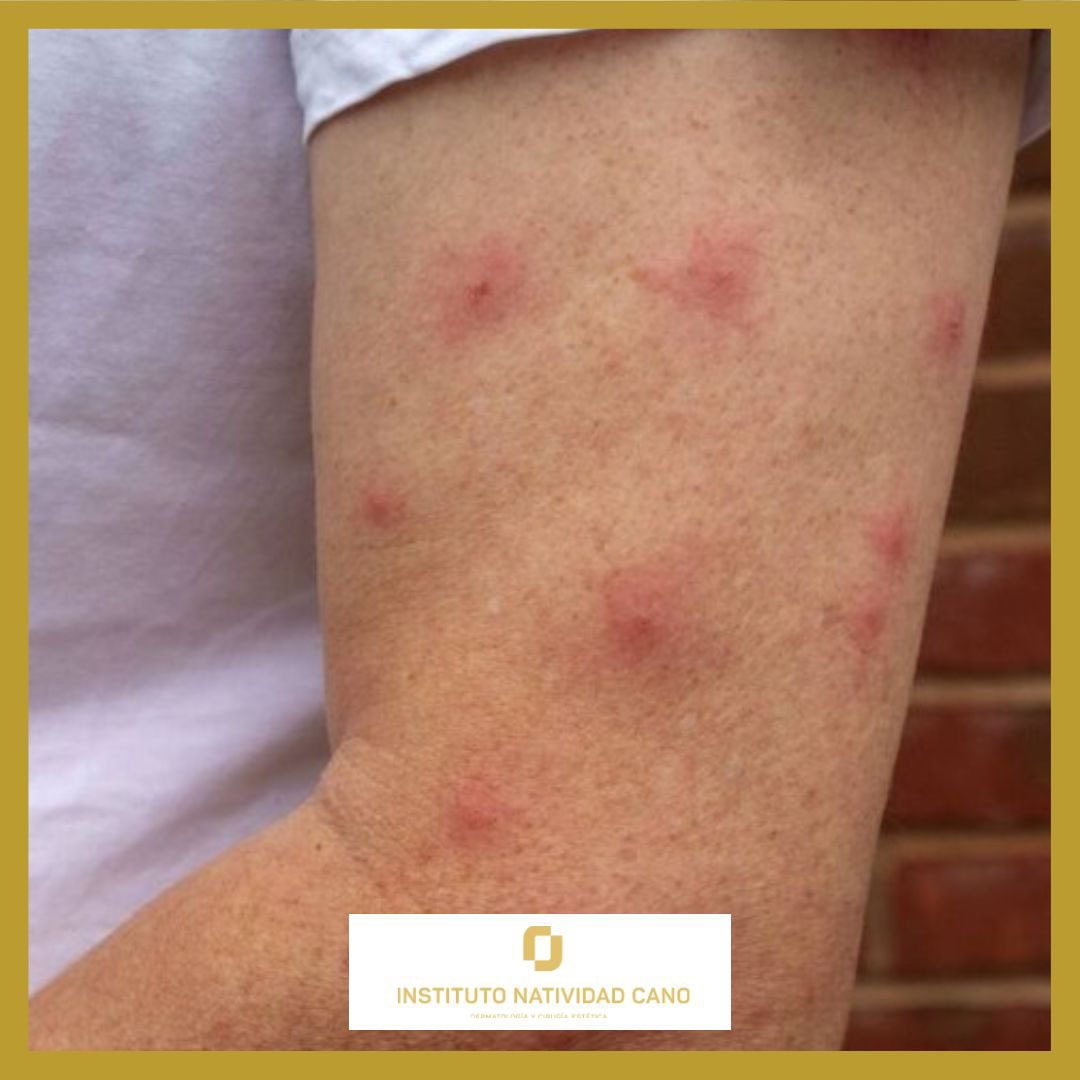 ¿Te pican los mosquitos? - Instituto Médico Natividad Cano