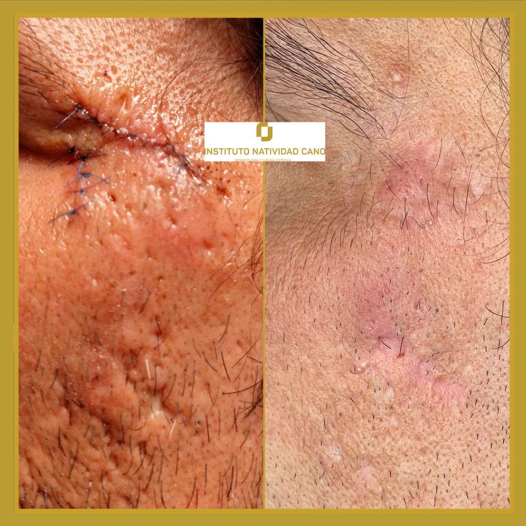 Acné y cicatrices de acné - Instituto Médico Natividad Cano